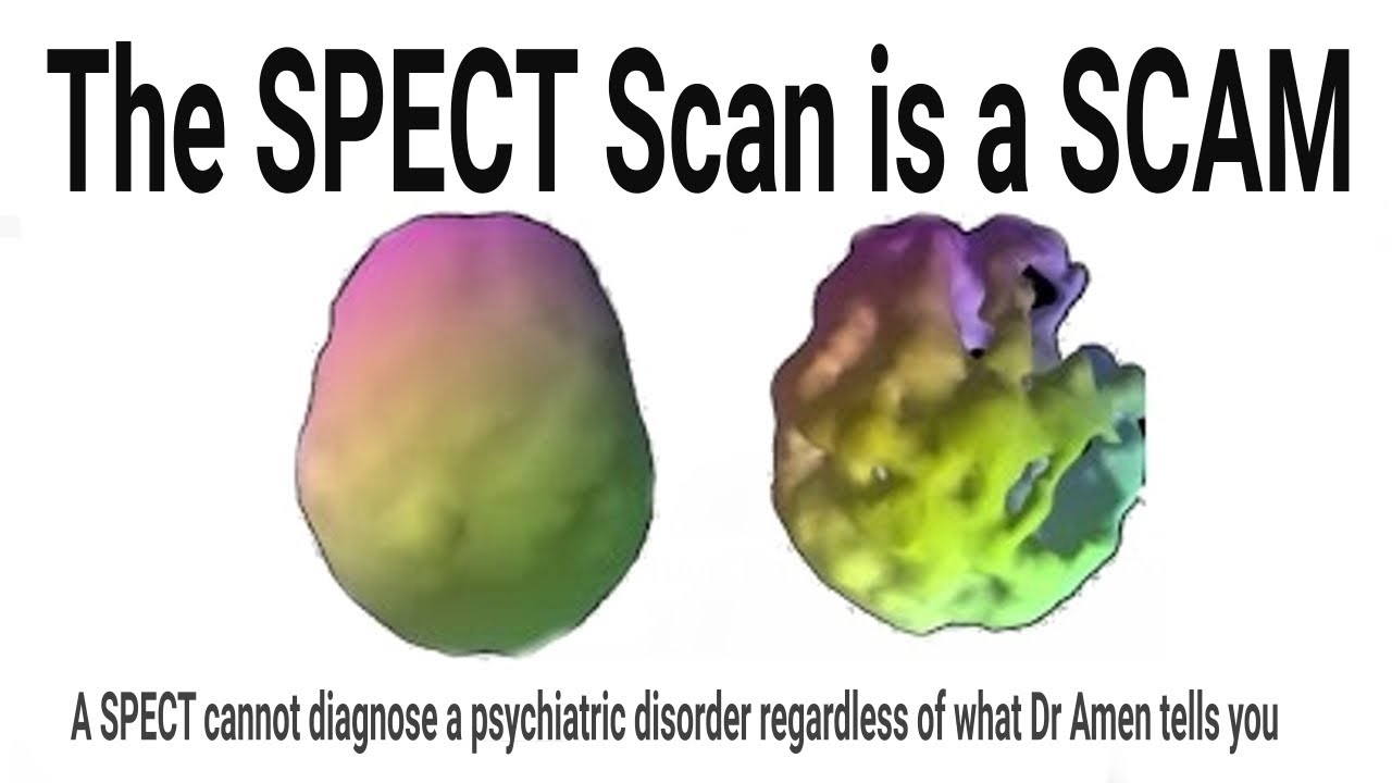Amen Clinics Spect Scan Scam An Alternate Viewpoint Youtube