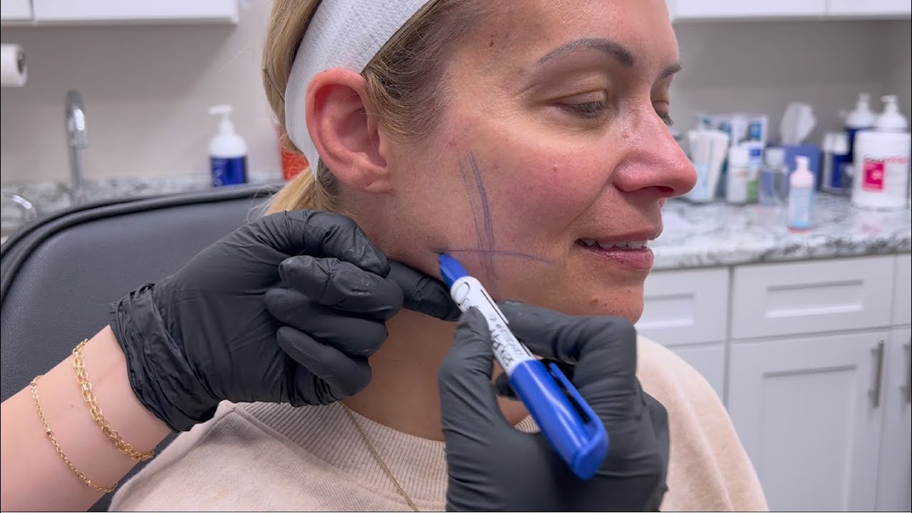 Incredible Instant Thread Lift With Vsoft Lifting Threads Youtube