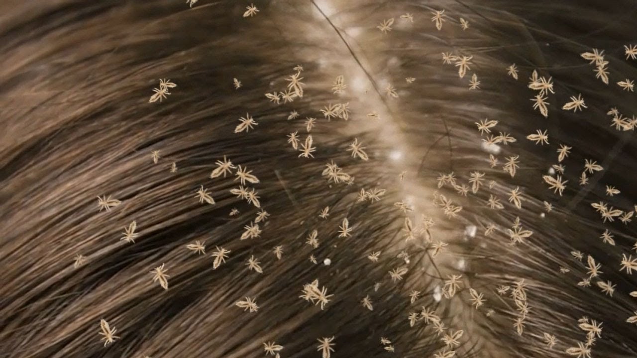 How To Kill And Get Rid Of Head Lice Treatment And Remedies