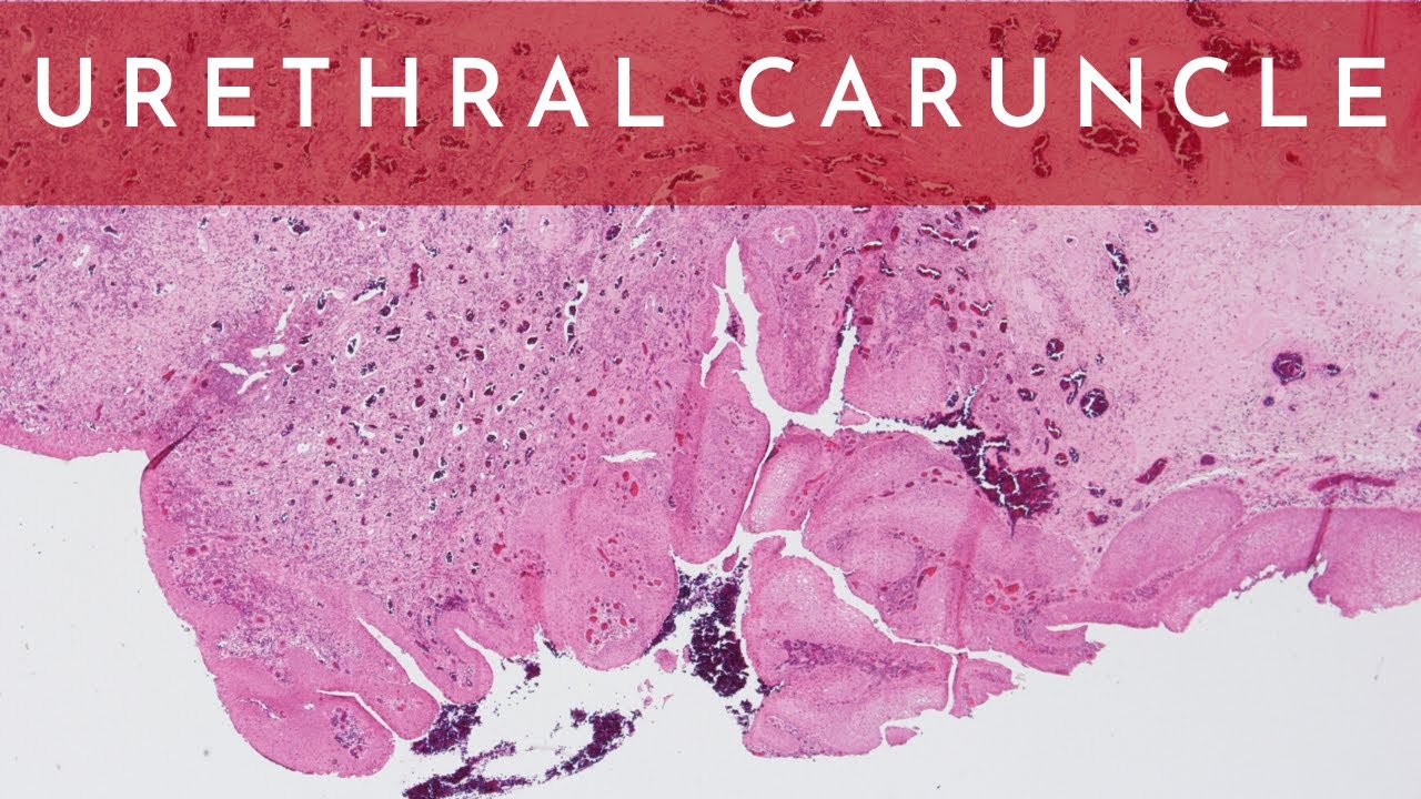 Urethral Caruncle Causes Symptoms And Treatment