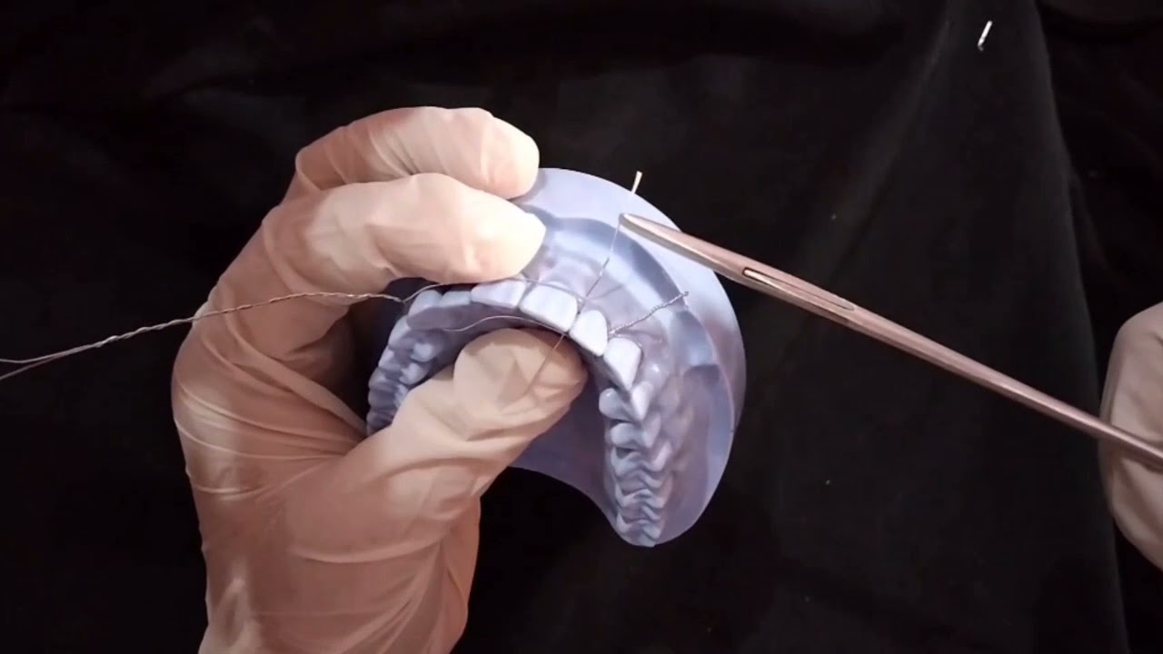 Teknik Splinting Essig S Wiring Teknik Col Stout S Multiloop Wiring