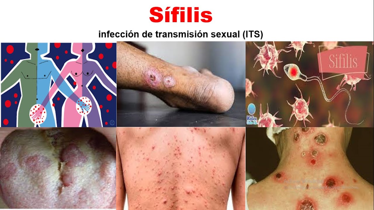 Sifilis Enfermedad De Transmision Sexual Youtube