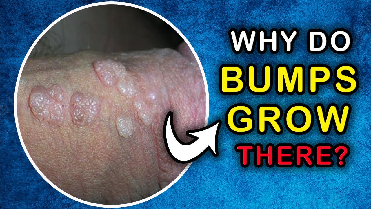Types Of Bumps You Will Find Your Pubic Area As Male Youtube
