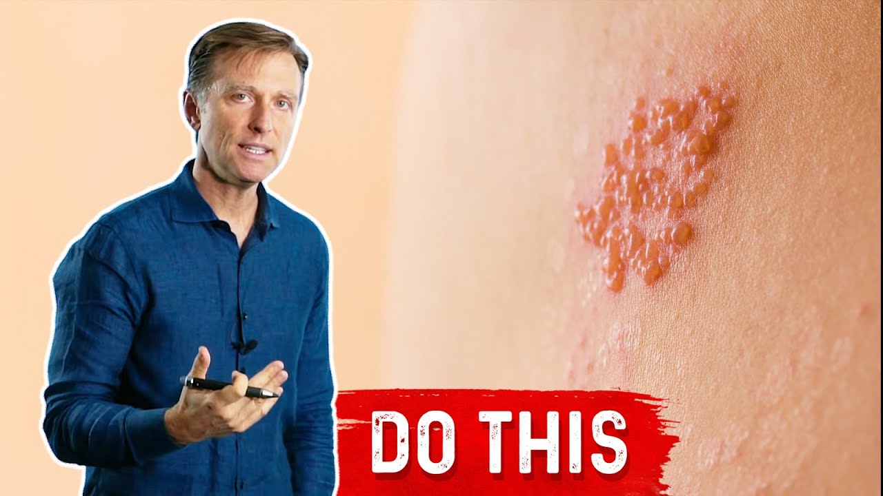 How To Deal With Ringworm Naturally Youtube