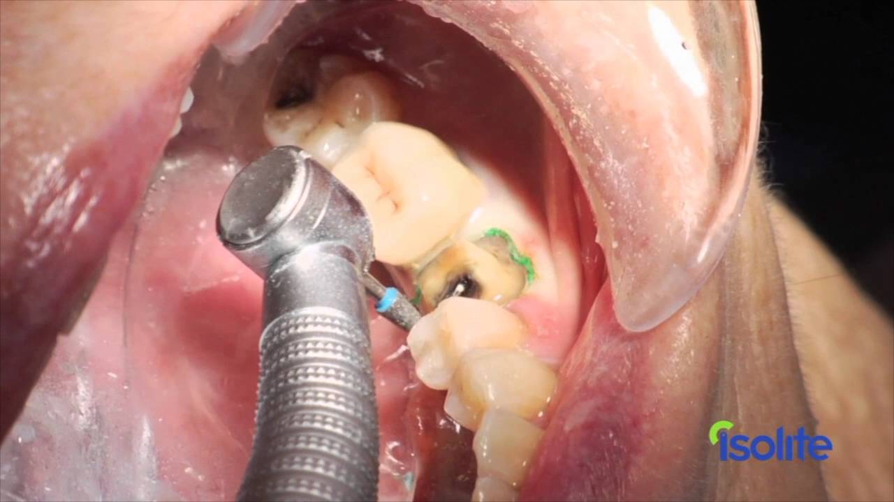 What Is Isolation In Dentistry At Julia Kromer Blog