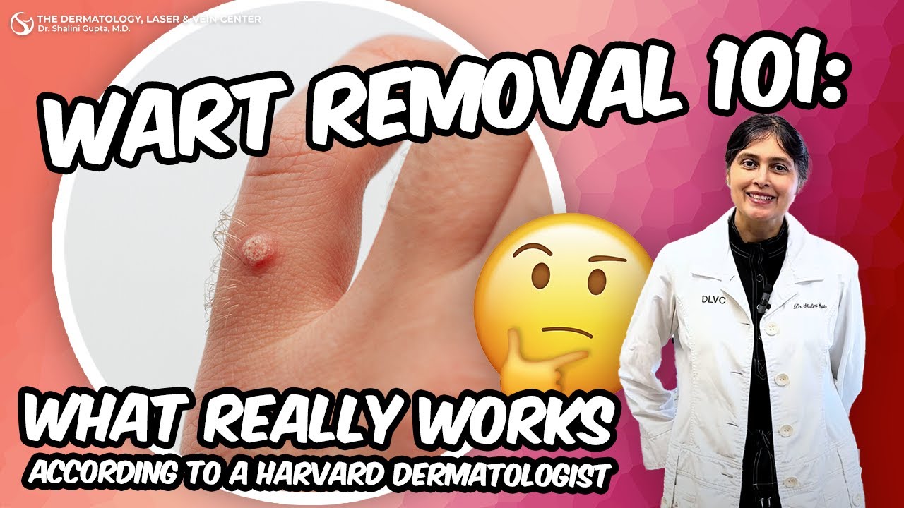 Wart Removal 101 What Really Works According To A Harvard
