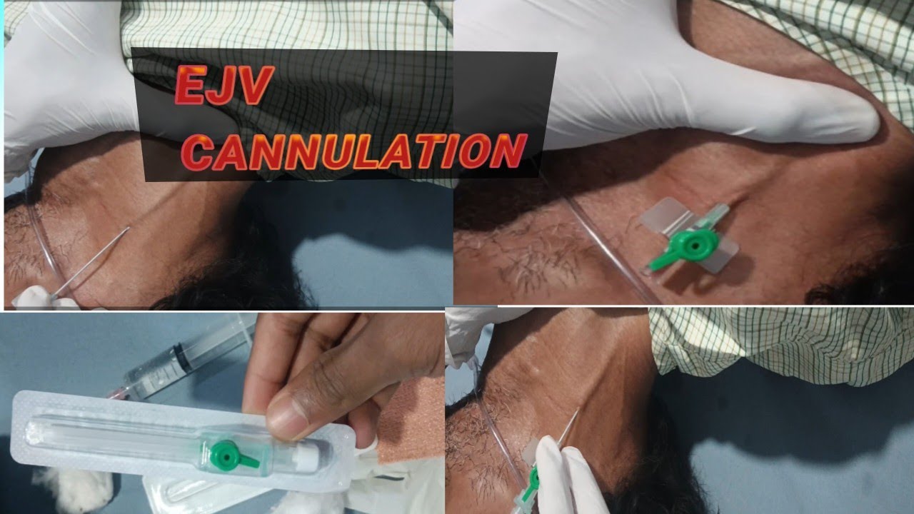 Ejv External Jugular Vein Cannulation Ejv Cannulation Technique