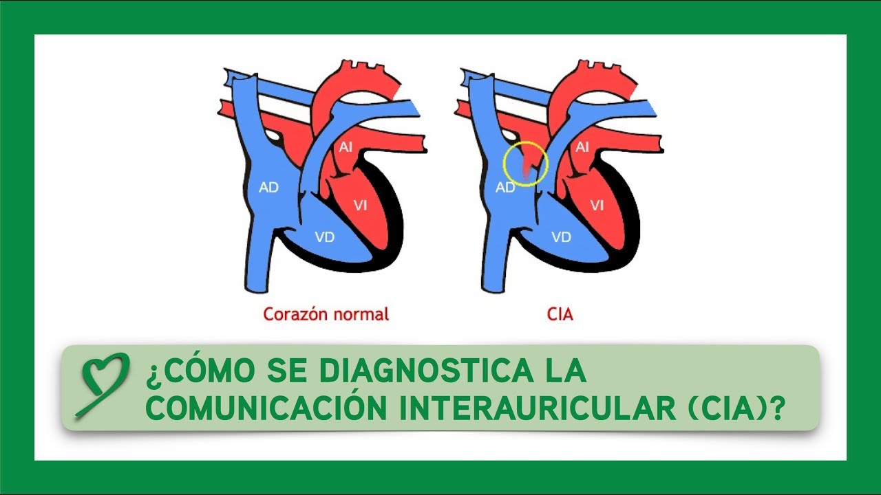 Cómo Se Diagnostica La Comunicación Interauricular Cia Youtube
