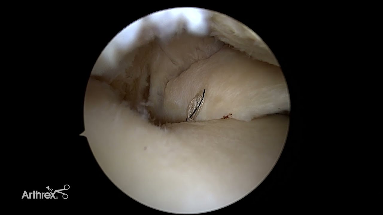 Fix And Stitch Augmented Posterior Meniscus Root Repair Youtube
