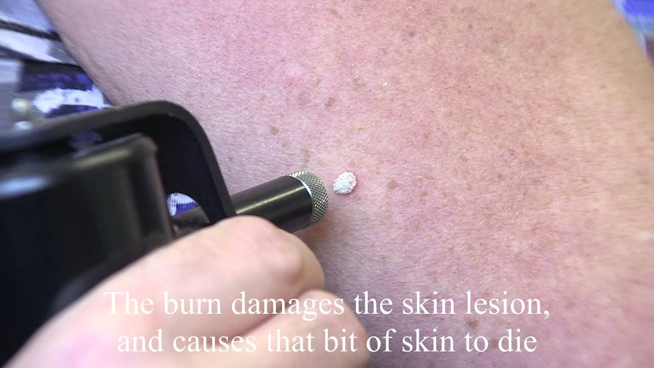 Liquid Nitrogen For Treating Skin Lesions Youtube