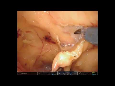 Management Of Cord Lipoma With Lymphatics During Rtapp Right Inguinal