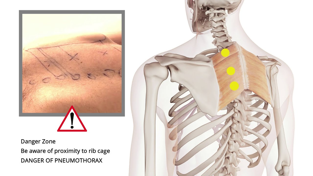 Trigger Point Release Shoulder Pain Rhomboids Youtube