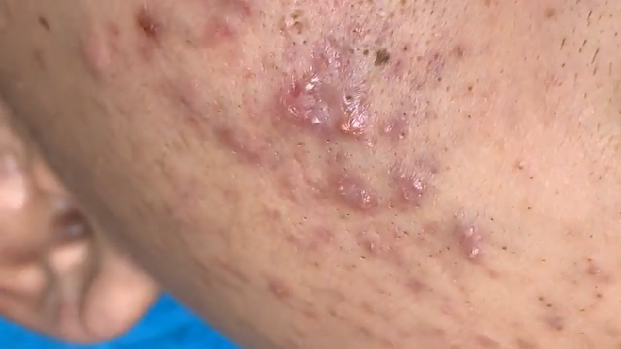 Relax With Massive Cystic Acne Popping Video