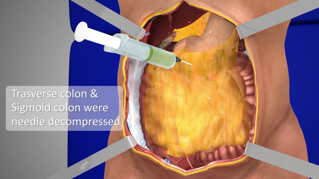 Exploratory Laparotomy 3d Medical Animation Part 1 Films