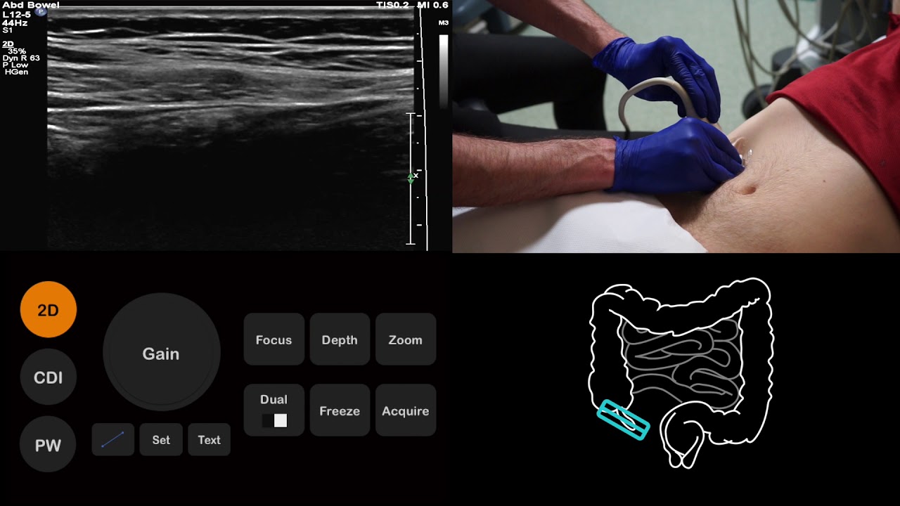 Ultrasound Tutorial Appendix Appendicitis Non Audio Text Described