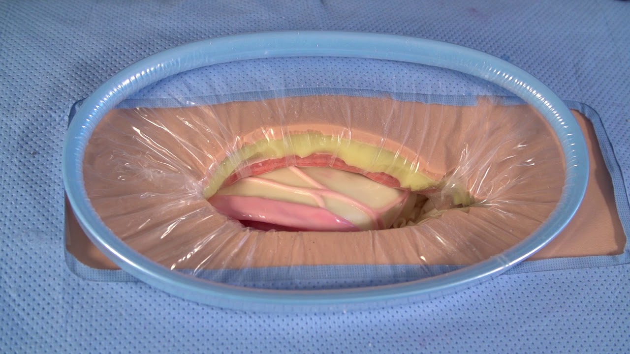 Hard Plastic Wound Cover At Lorelei Rios Blog