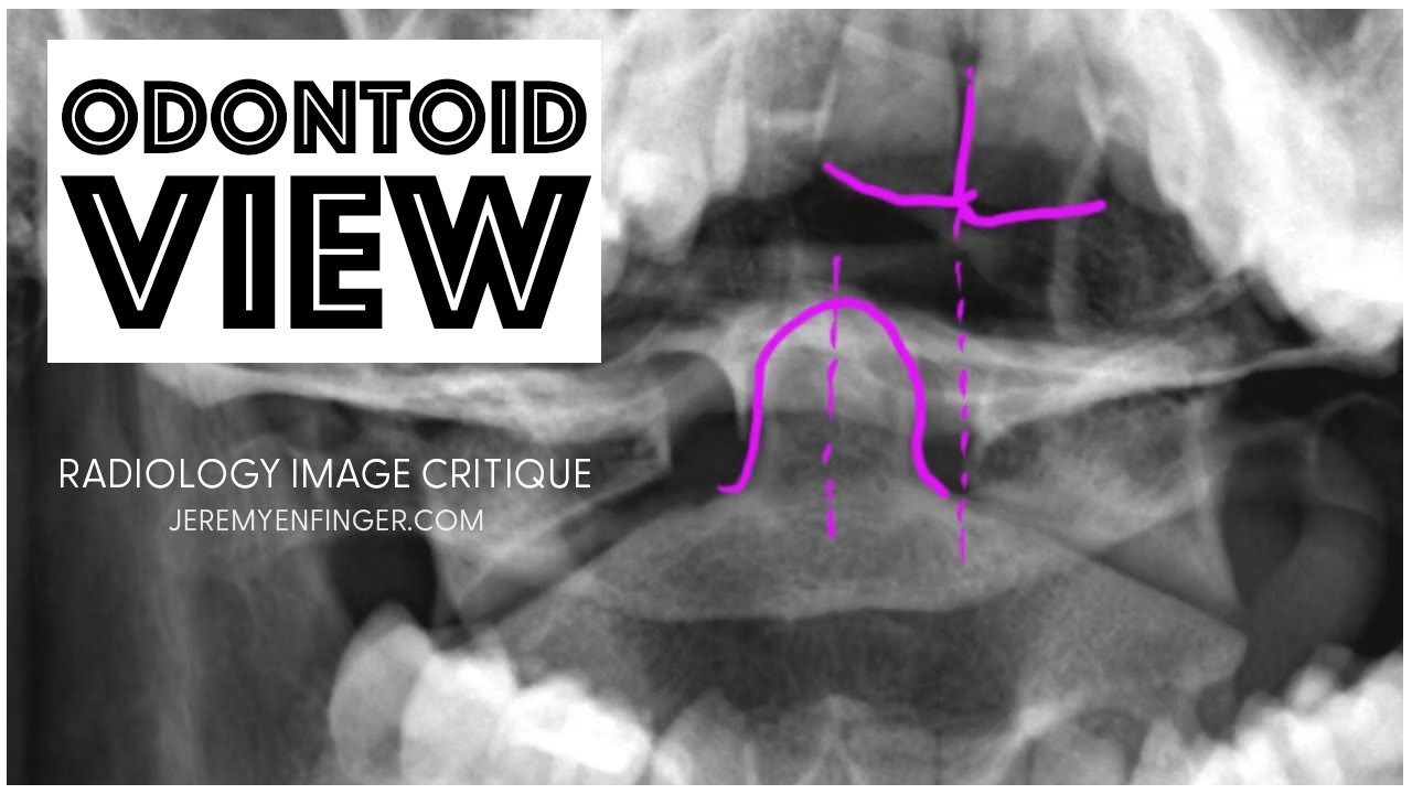 Radiology Image Critique Odontoid View Youtube