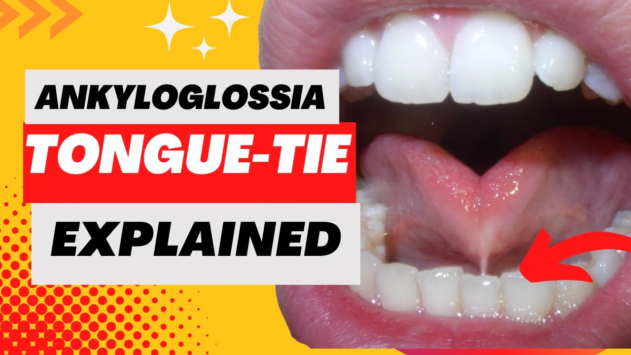 Tongue Tie Ankyloglossia Explained In 1 Minute Youtube