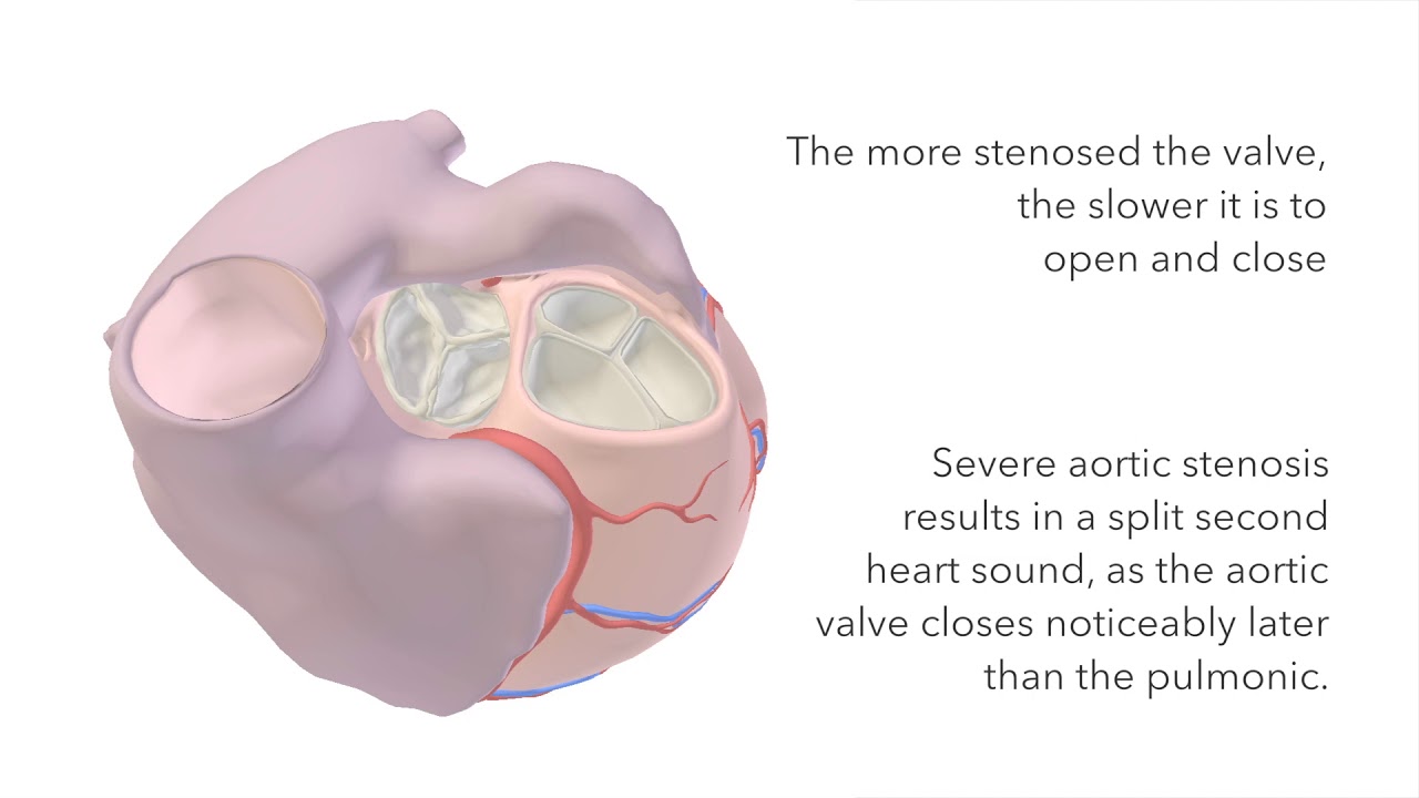 Aortic Stenosis Murmur Sound Animation Youtube