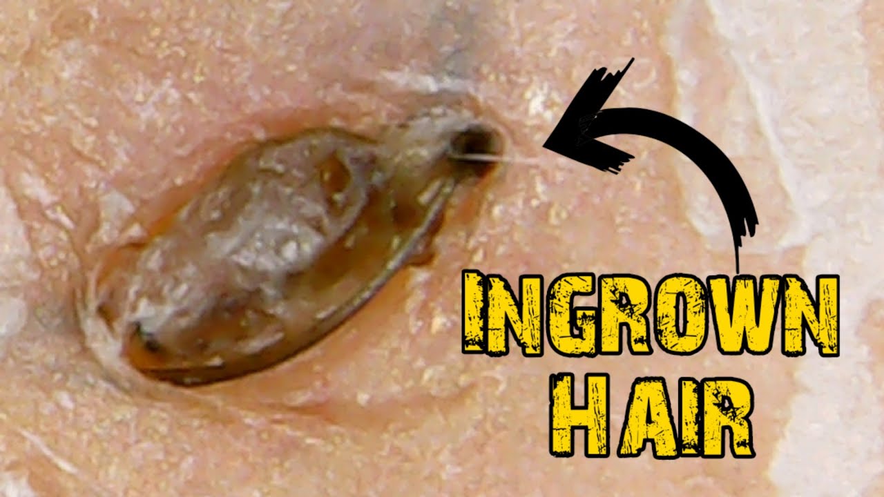 Ingrown Hair Removal X Satisfying Blackheads Youtube