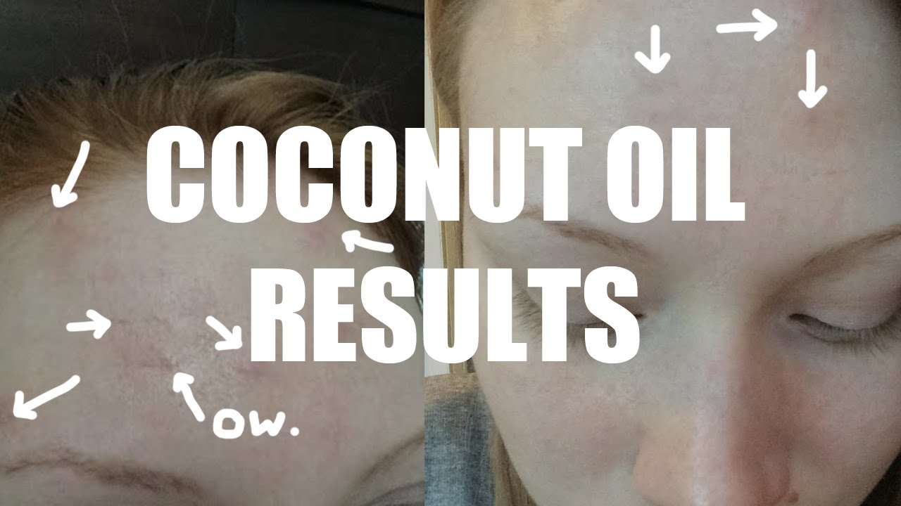 Coconut Oil Results Youtube