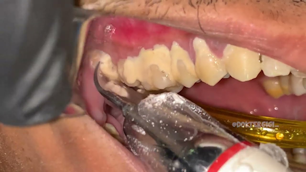 Dental Cleaning Youtube