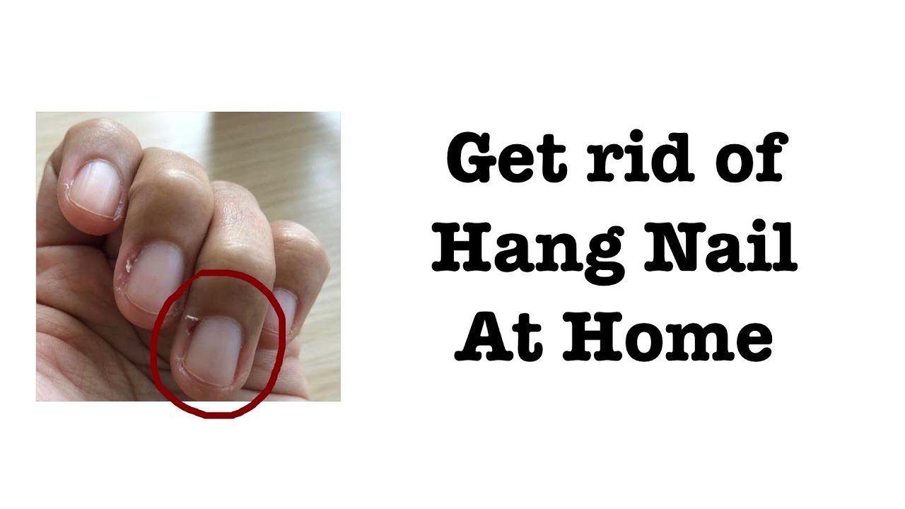 How To Get Rid Of Hangnail Youtube