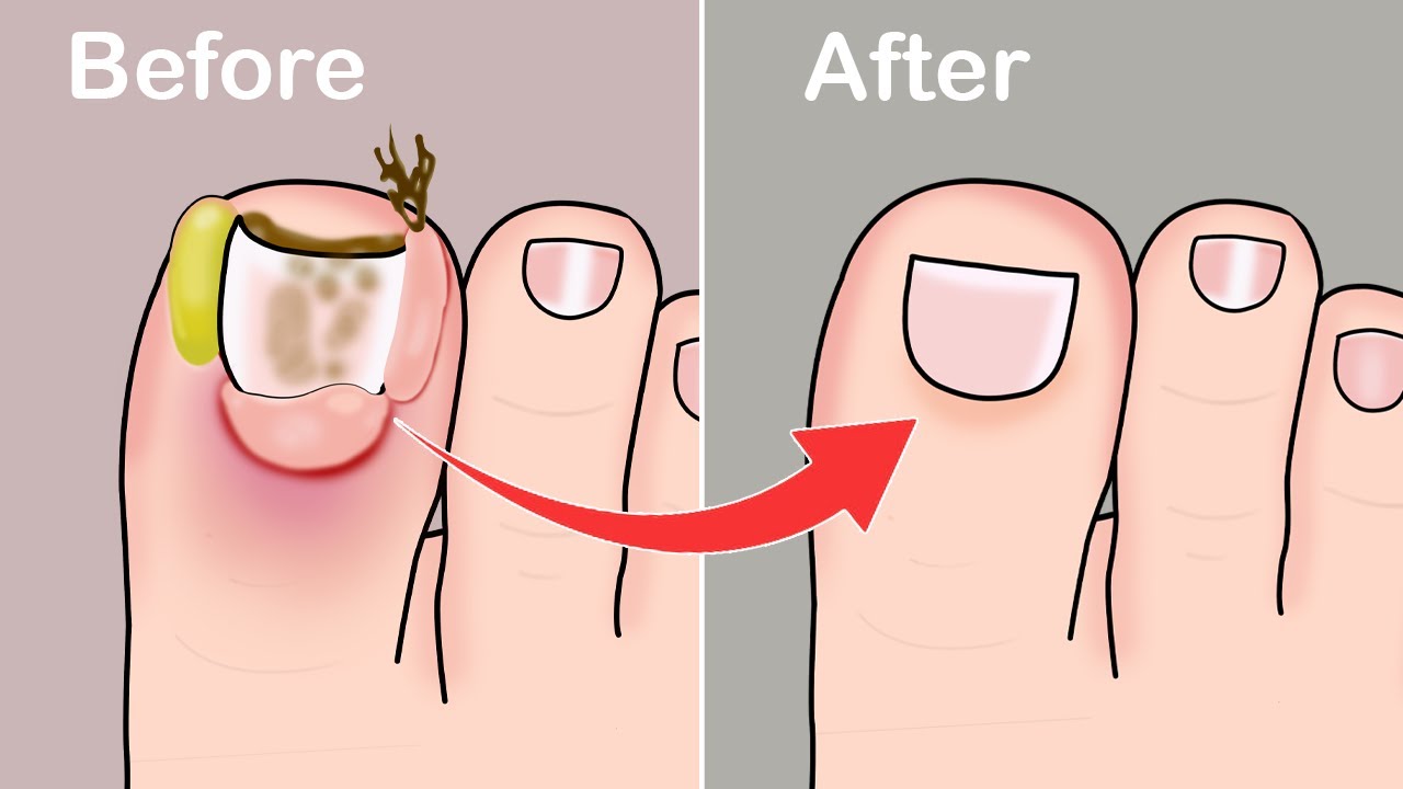 Asmr Satisfying Ingrown Toenail Removal Treatment Animation Youtube