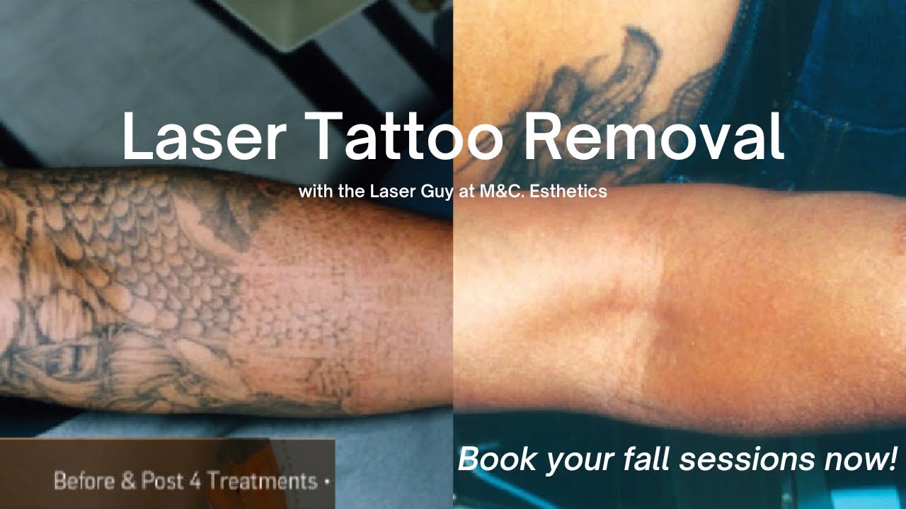 Laser Tattoo Removal With The Cynosure Revlite Si Youtube