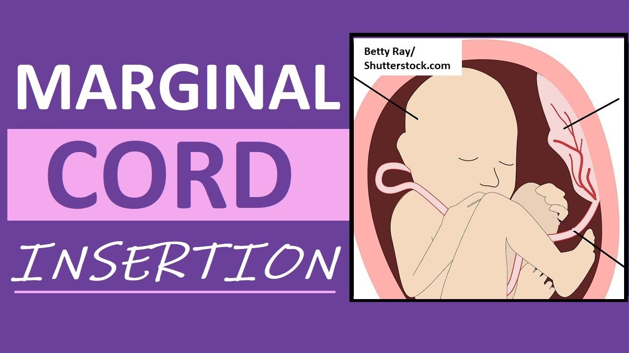 Marginal Cord Insertion Placenta Experience Pregnancy Birth Vlog