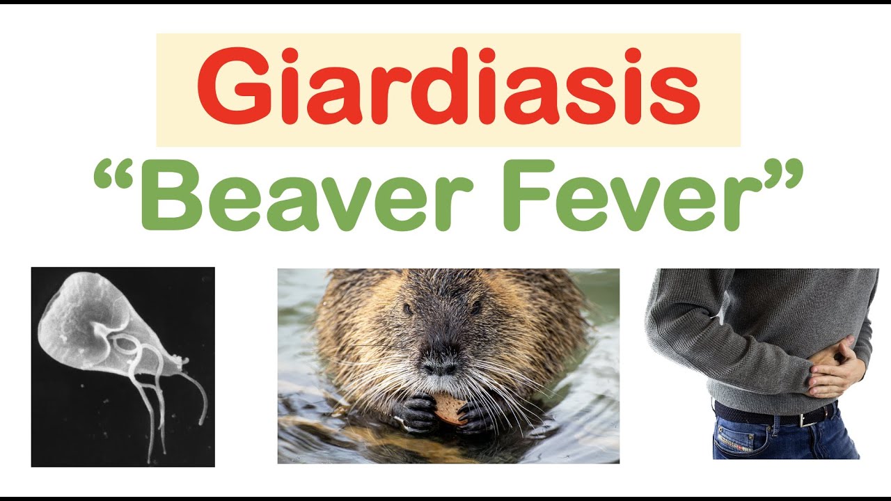 Giardiasis Beaver Fever Symptoms Causes Diagnosis Giardiasis