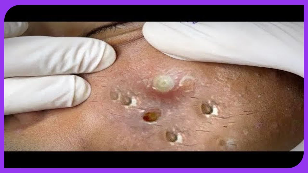 Satisfying Blackheads Removal Pimple Popping On Skin 2024 Youtube