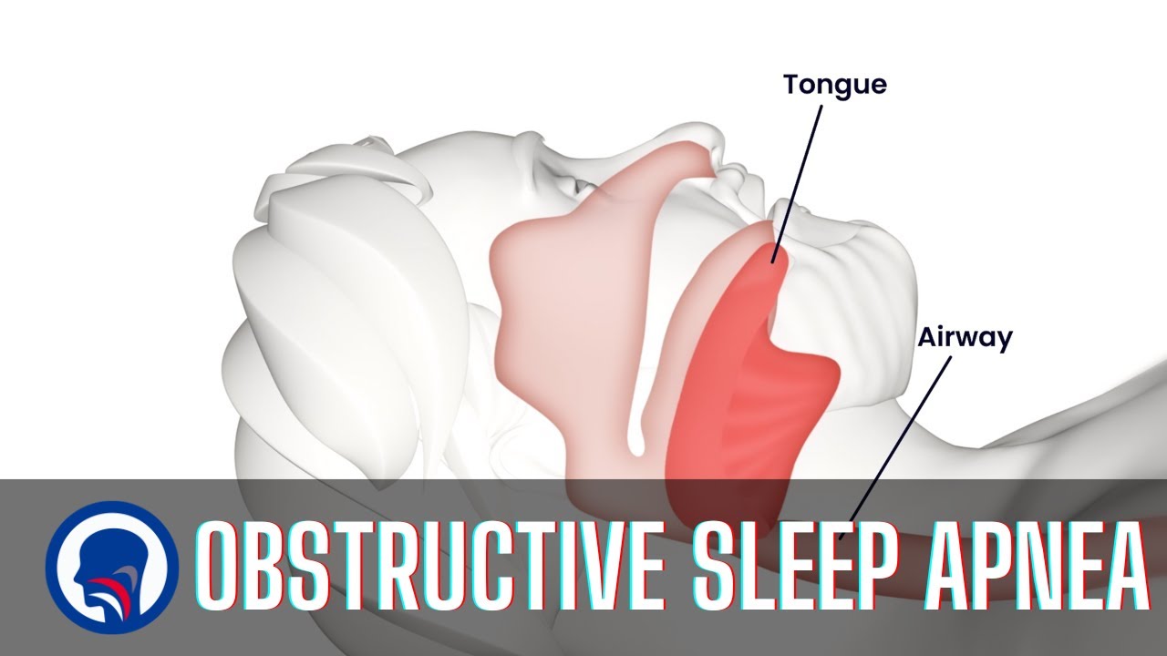 Obstructive Sleep Apnea Youtube