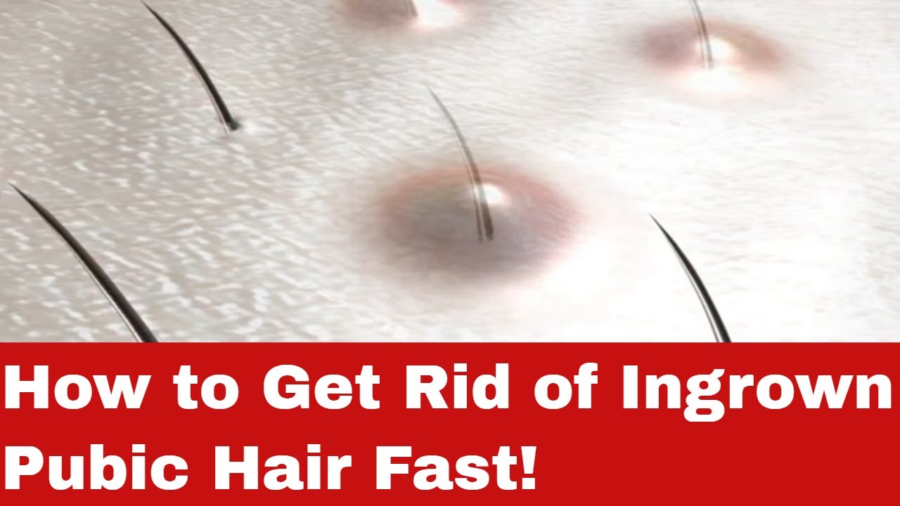 How To Get Rid Of Ingrown Pubic Hair Safely And Effectively Youtube