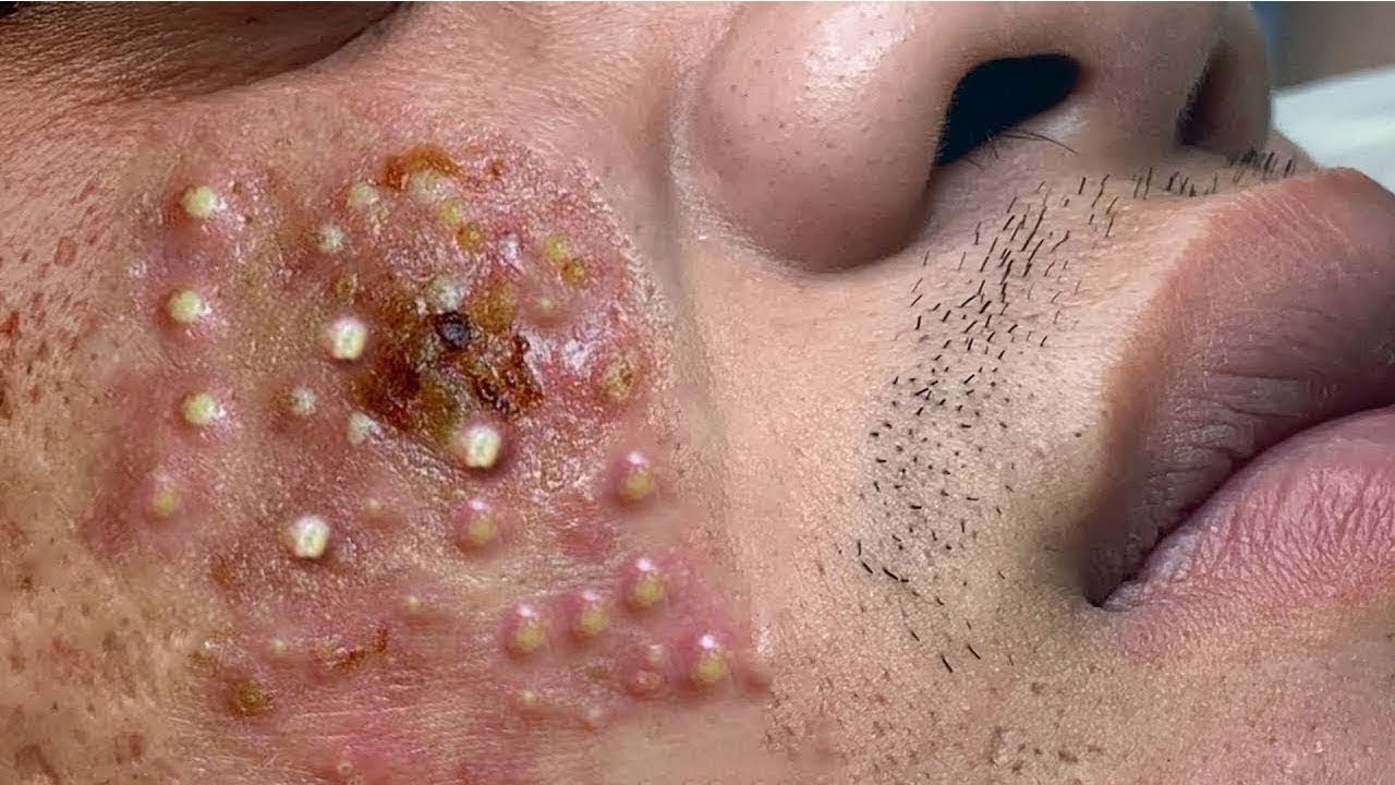 Big Cystic Acne Blackheads Extraction Blackheads Milia Whiteheads