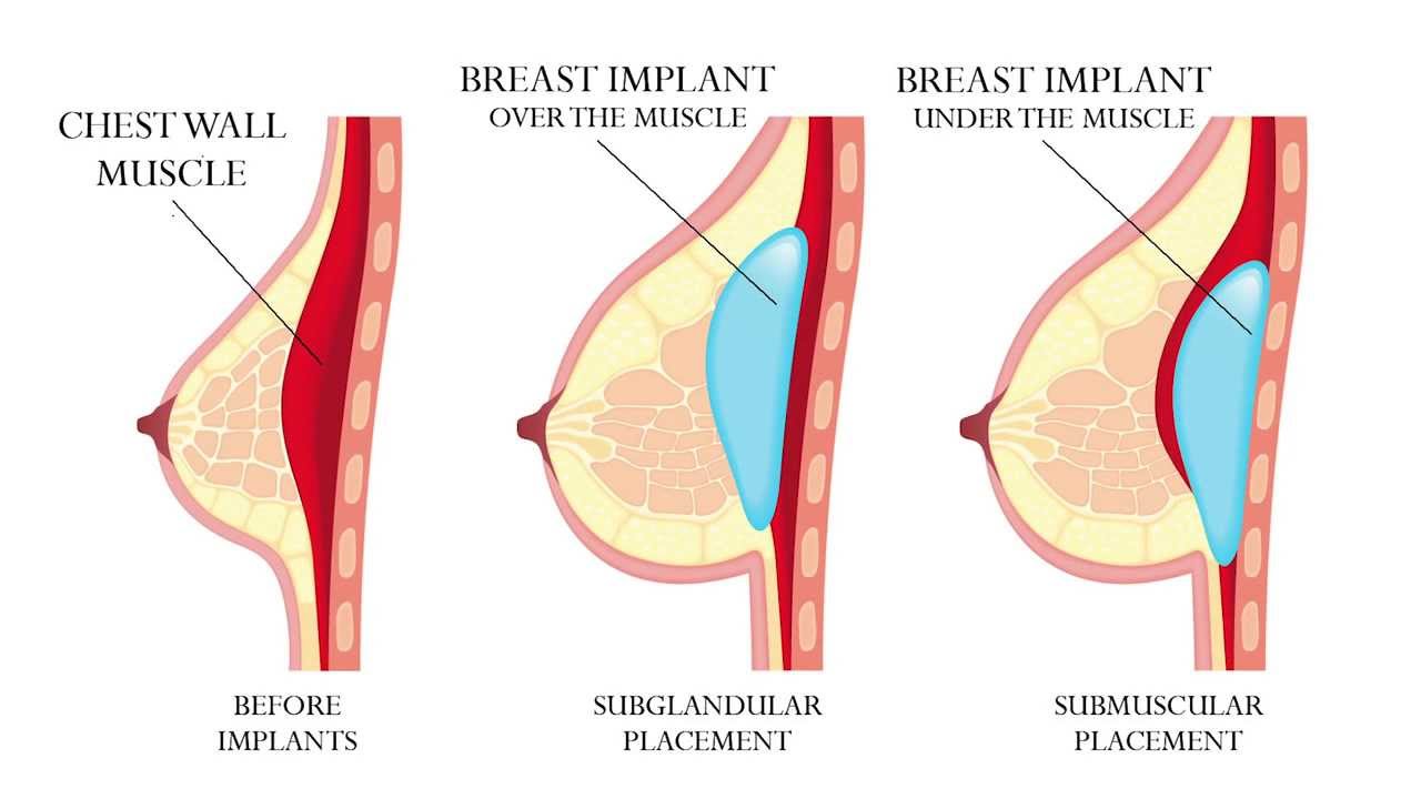 How Do You Get The Most Natural Looking Implants Ask Dr D Youtube
