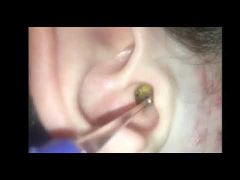 Ear Cleaning Youtube