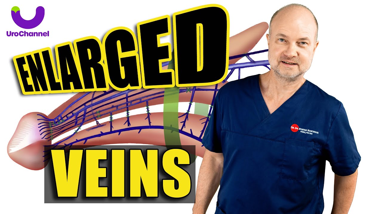 The Truth About Enlarged Penile Veins Urochannel Youtube