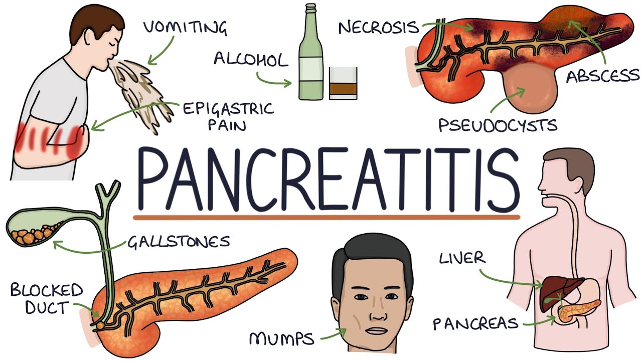 What Are Signs Symptoms Of Chronic Pancreatitis Espen Practical