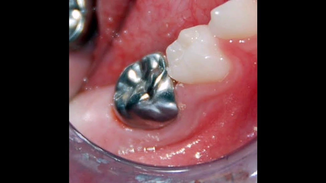 Coronas De Acero Cromo En Dientes Posteriores Youtube