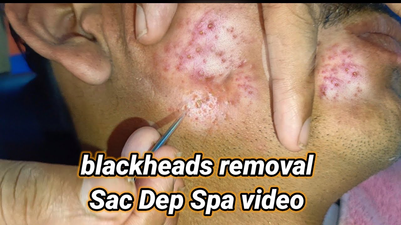 Satisfying Relaxing Blackhead Removal Sac Dep Spa Into Sac Dep Spa