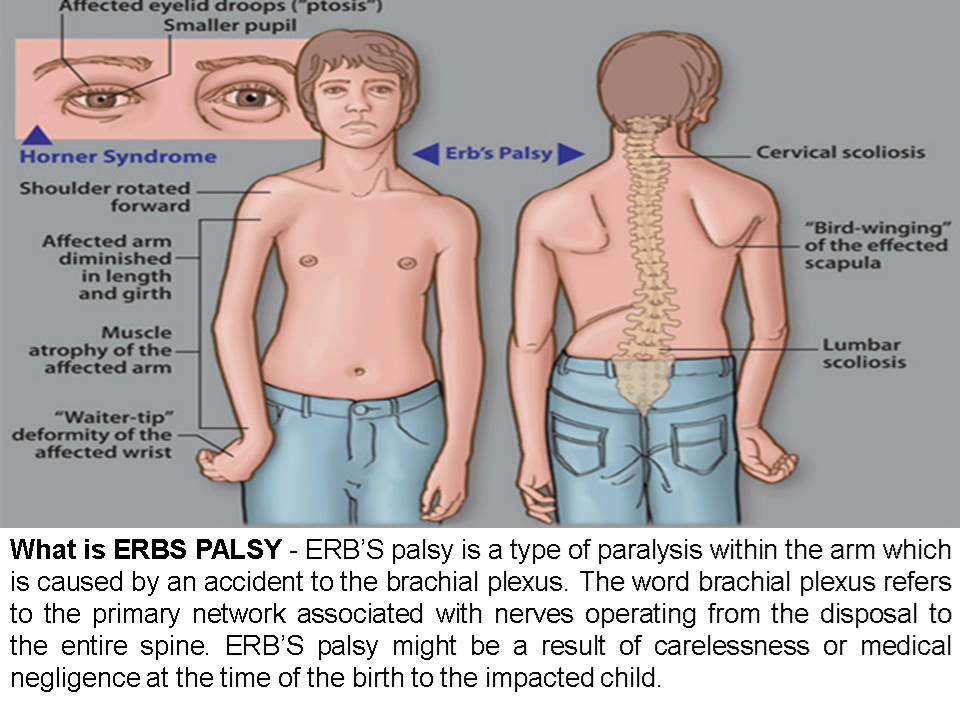 Erb S Palsy
