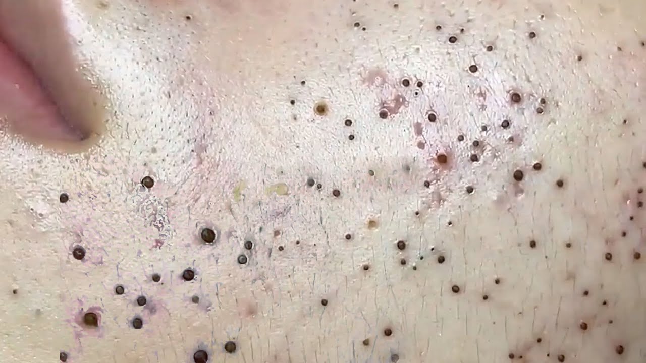 Life Is Wonderful Spa 25 So Many Blackheads Yellow Acne Carefully