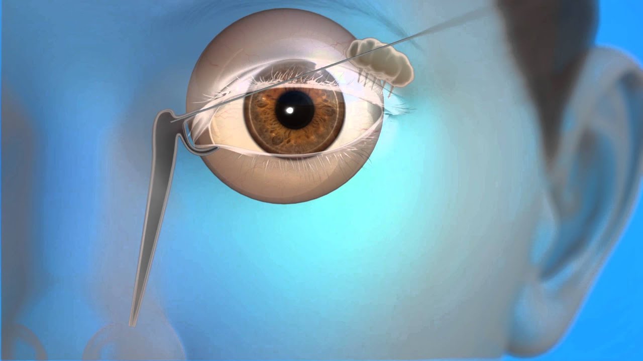 Tear Duct Probing Surgery Youtube