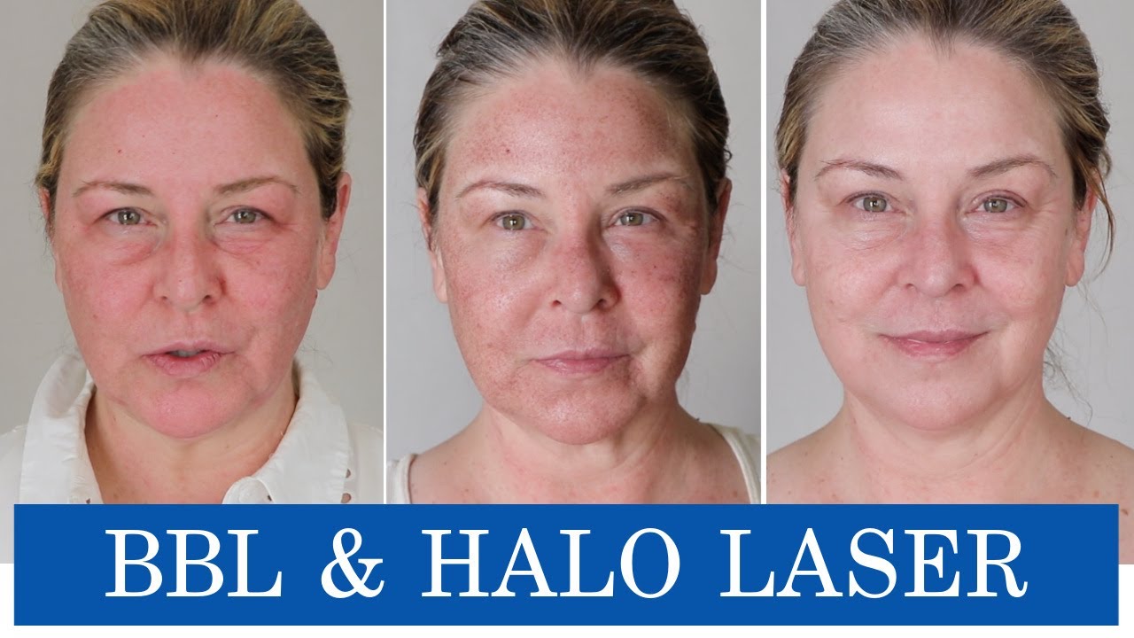 My Experience With Bbl Halo Laser Six Day Recovery Log Youtube