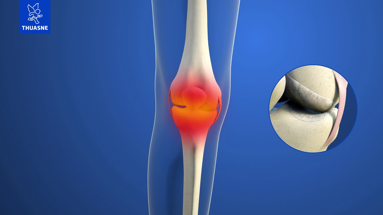 Comprendre L Arthrose Du Genou Youtube