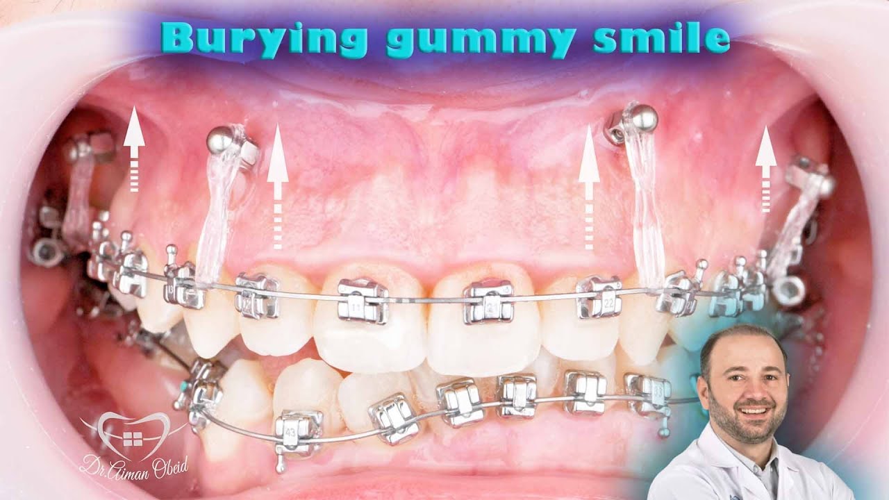 Gummy Smile Correction By Mini Implants Upper Teeth Lifting