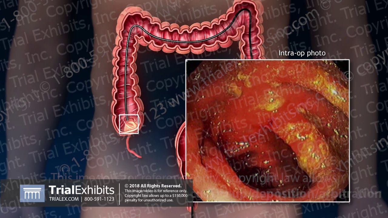 Polyps In Colon Can They Bleed At Reynaldo Leahy Blog