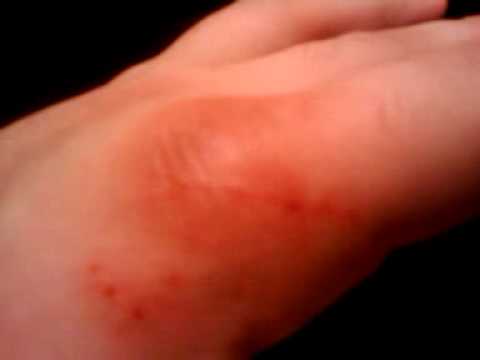 Ball Python Bite Youtube