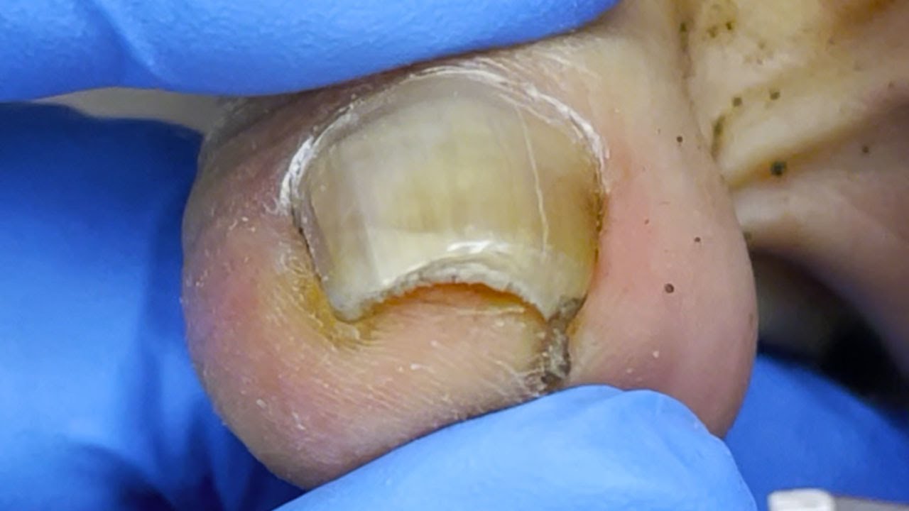 Why Are My Toenails Curved At Jack Oneill Blog